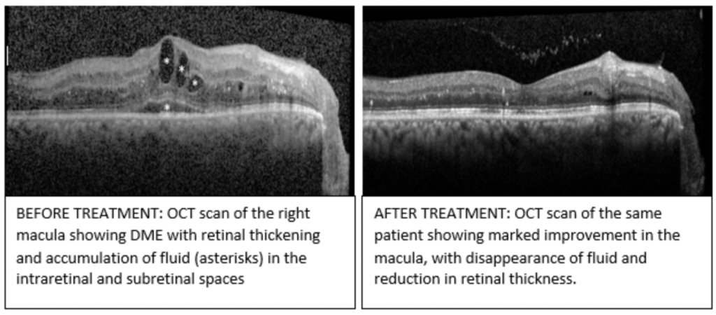 Diabetic Macular Edema (DME) - OasisEye Specialists