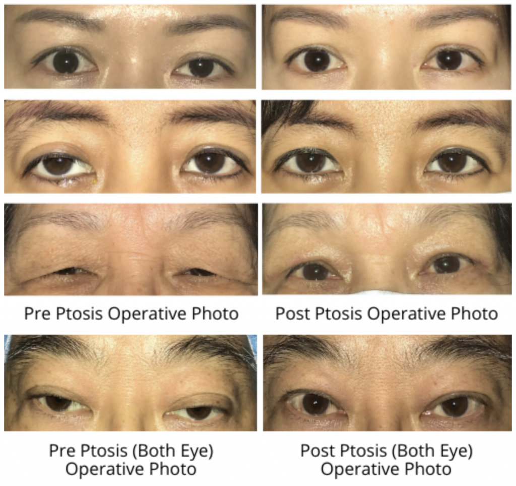 Droopy Eyelids - OasisEye Specialists