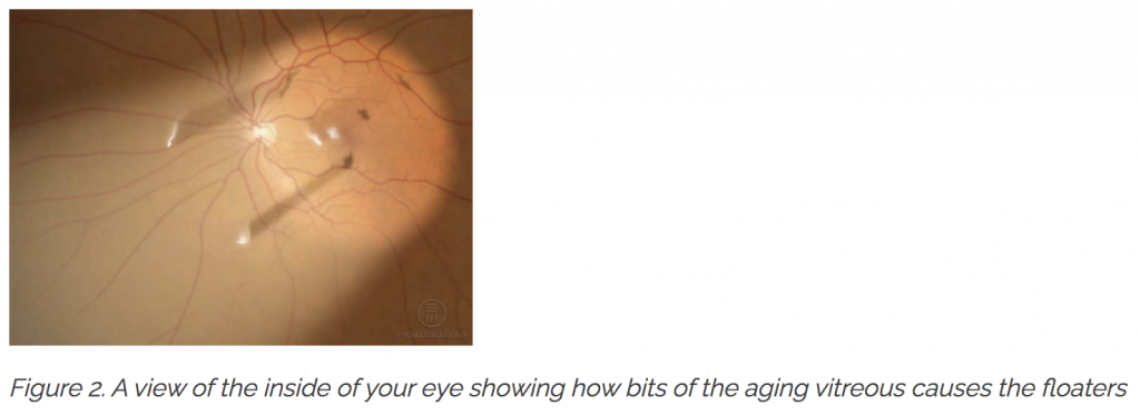 Floaters - OasisEye Specialists