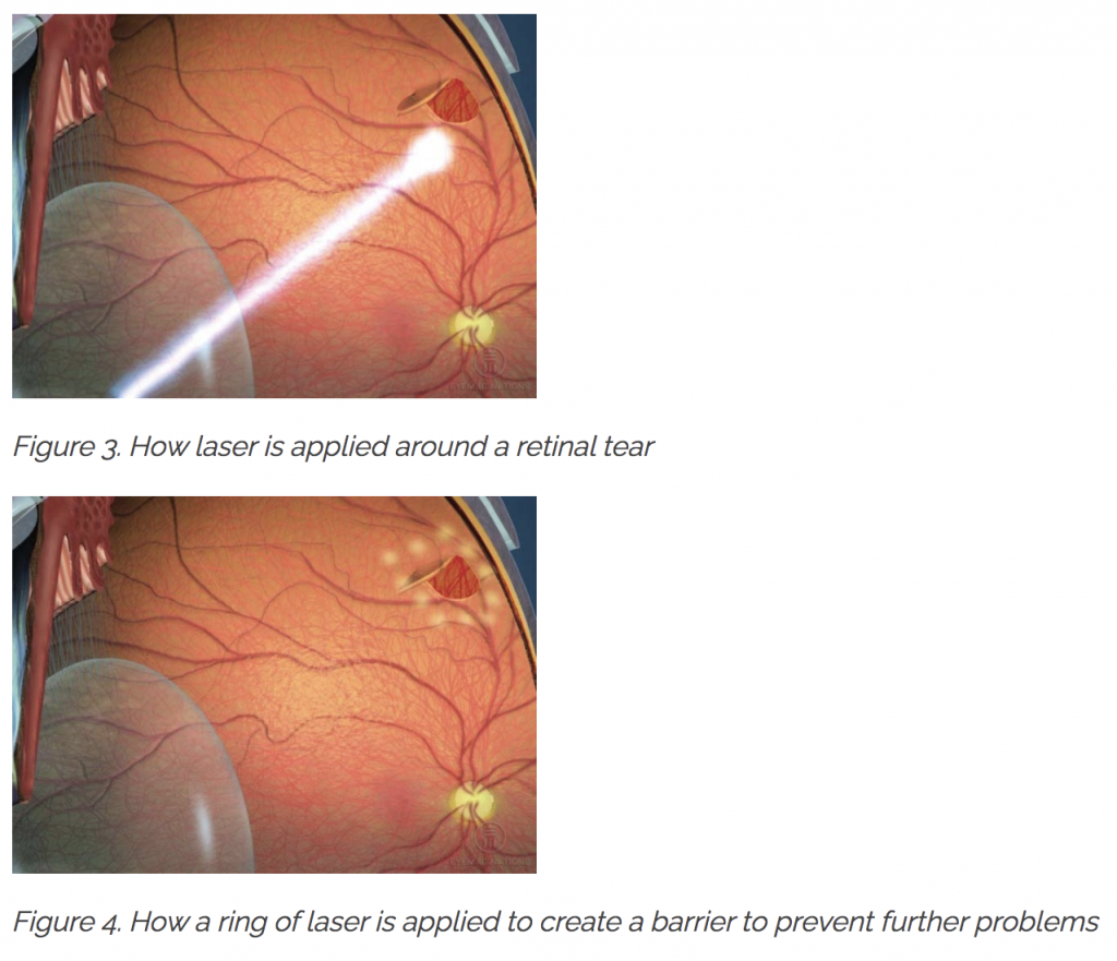 Floaters - OasisEye Specialists