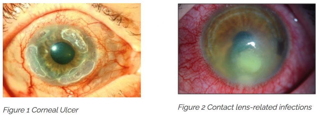 Corneal Infections - OasisEye Specialists