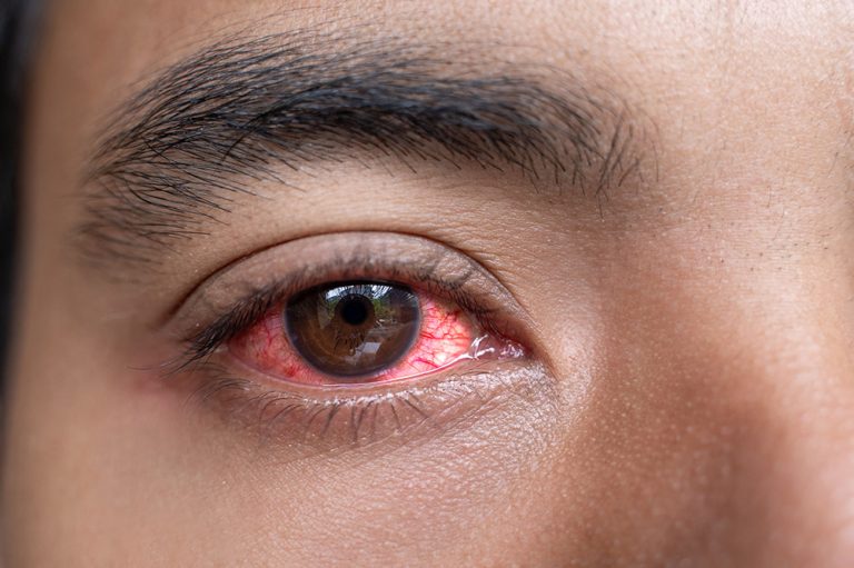 Red Eyes Problem | Red Eye Treatment in Kuala Lumpur (Malaysia)