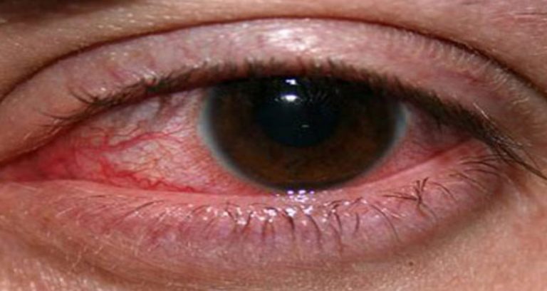 UV Light & its effects to the eye - OasisEye Specialists