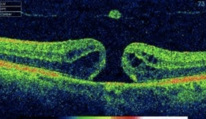 Macular Hole - OasisEye Specialists Macular Hole - OasisEye Specialists
