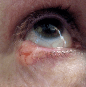 Comprehensive Guide to Eyelid Growths: Types, Causes, and Treatments
