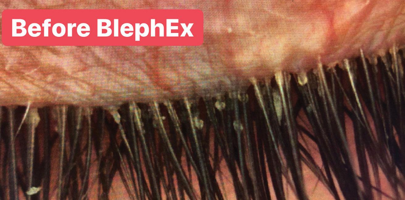 Eyelid Hygiene Devices - BlephEx & Blephasteam Treatments