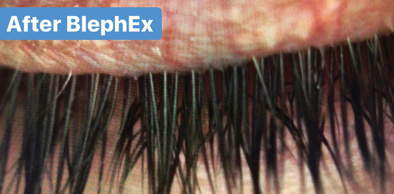 Eyelid Hygiene Devices - BlephEx & Blephasteam Treatments