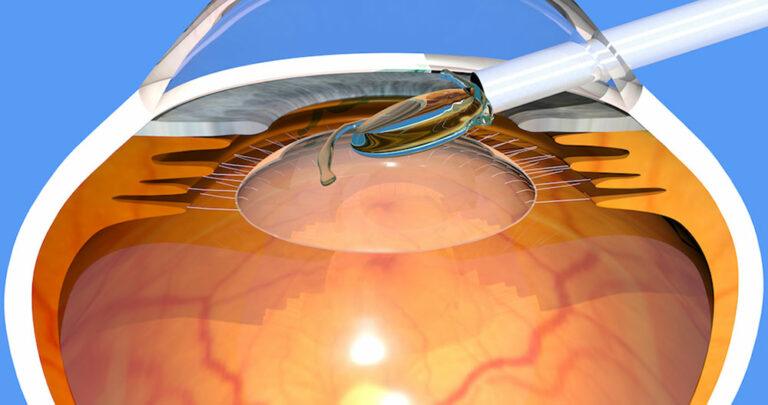 Multifocal Intraocular Lens (IOL) Treatment | OasisEye